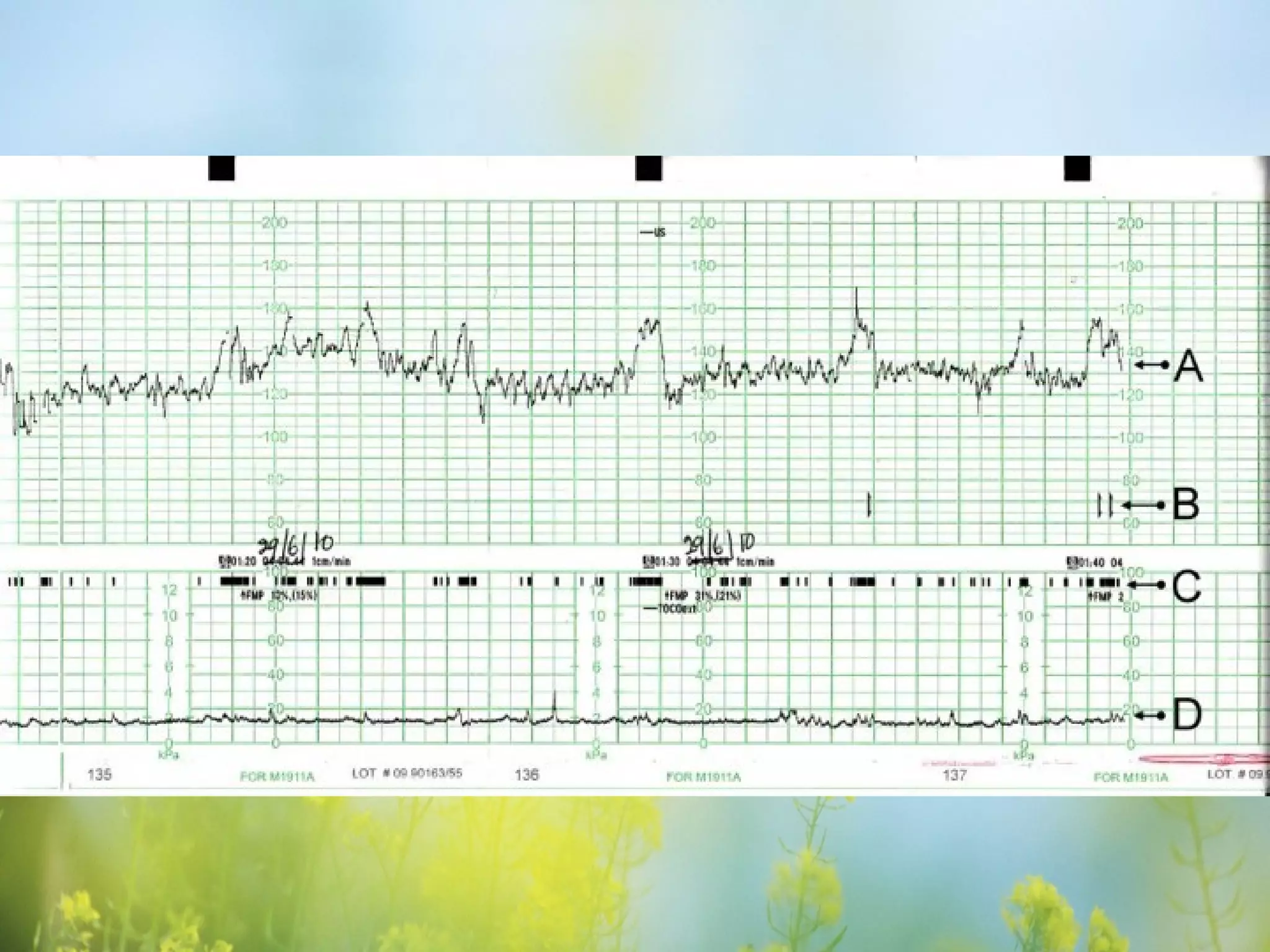 Normal and abnormal labour | PPT