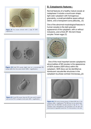 Normal and abnormal oocyte morphology | PDF