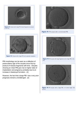 Normal and abnormal oocyte morphology | PDF