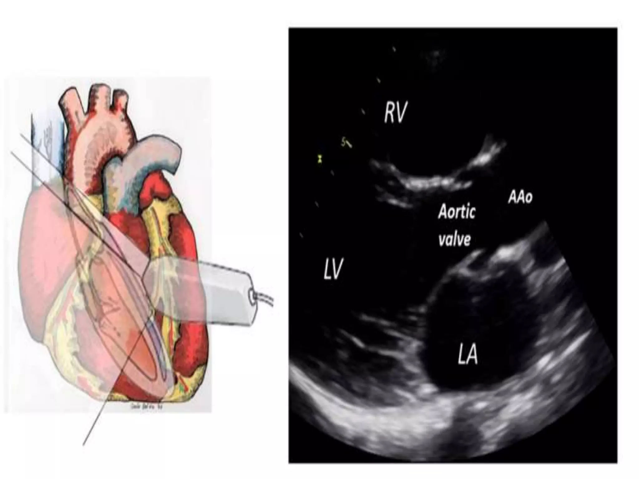 Normal aortic valve echocardiogram | PPTX