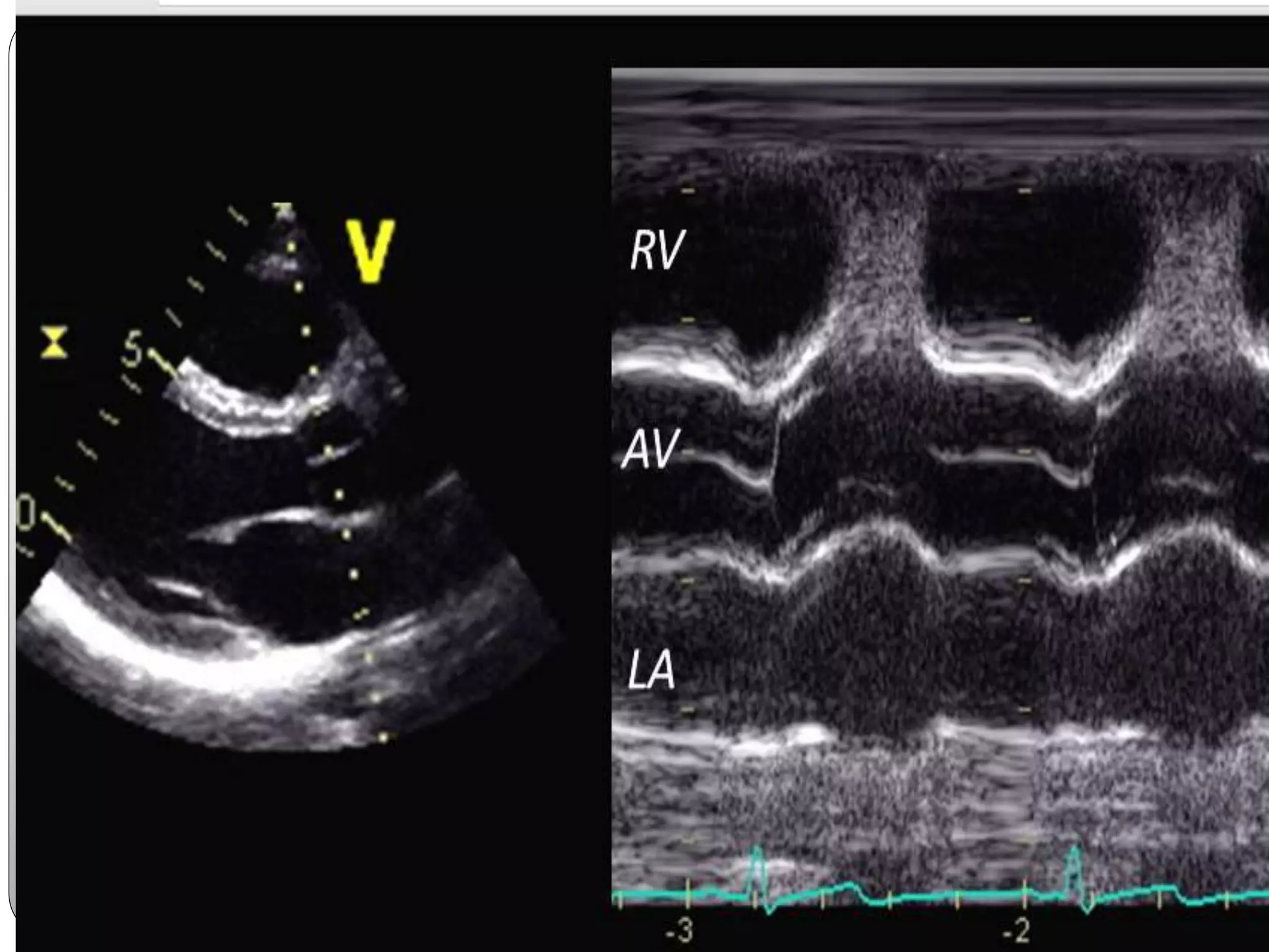 Normal aortic valve echocardiogram | PPTX