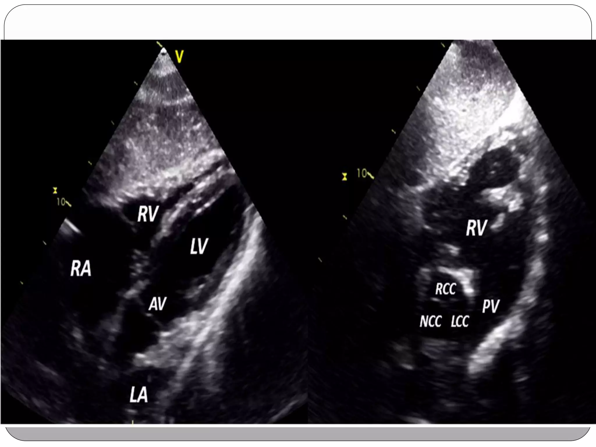 Normal aortic valve echocardiogram | PPTX