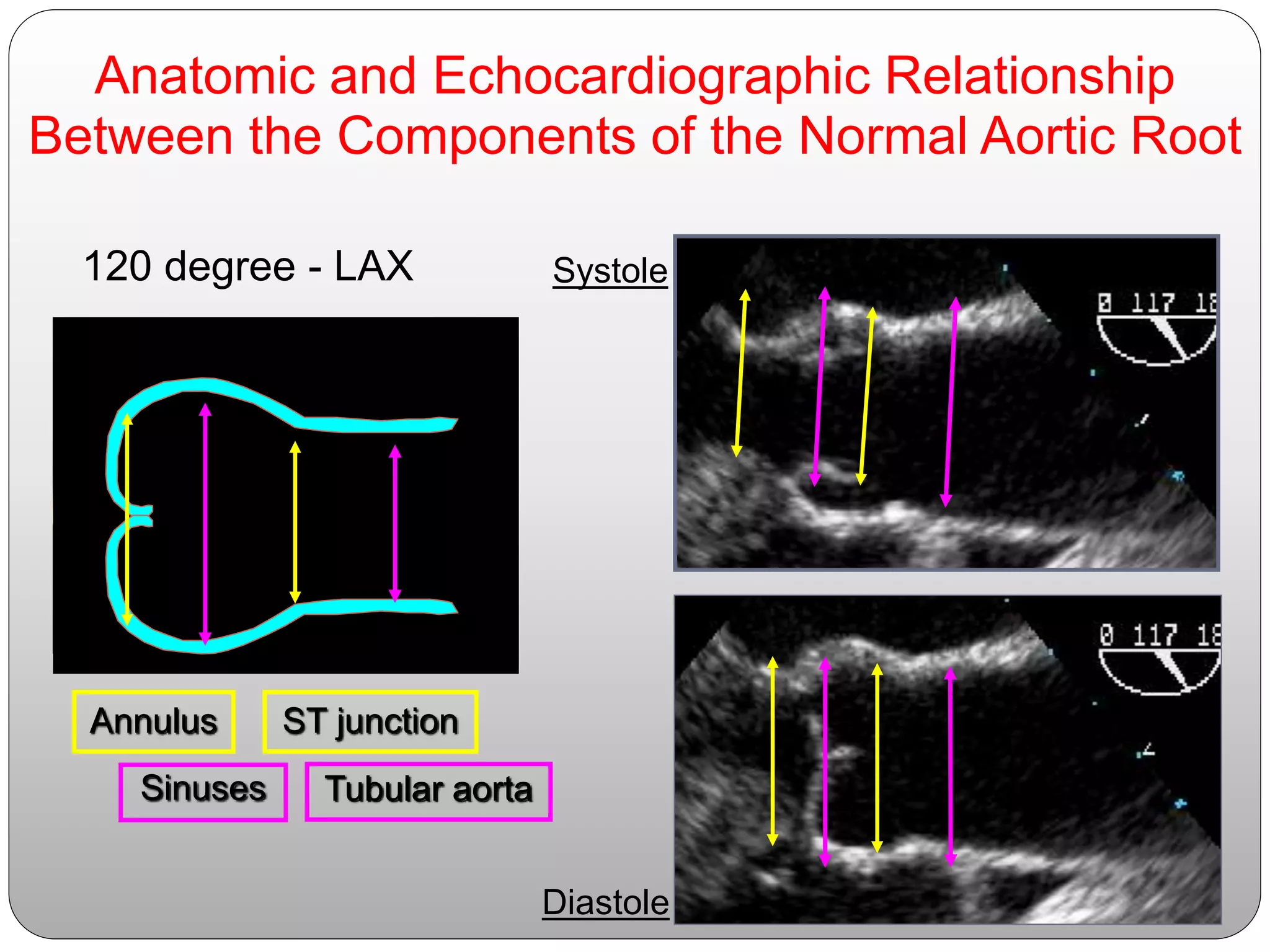 Normal aortic valve echocardiogram | PPTX