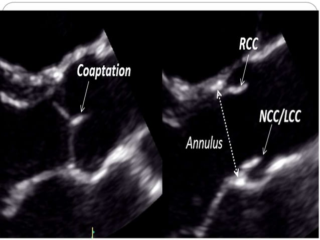 Normal aortic valve echocardiogram | PPT