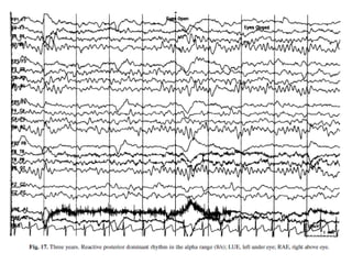 Normal awake and sleep EEG | PPT