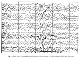 Normal awake and sleep EEG | PPT