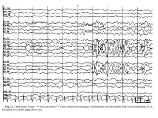 Normal awake and sleep EEG | PPT