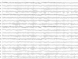 Normal awake and sleep EEG | PPT