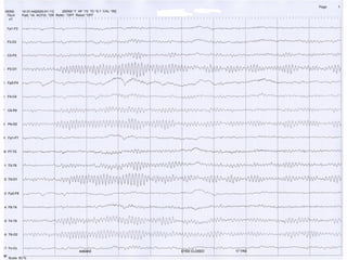 Normal awake and sleep EEG | PPT