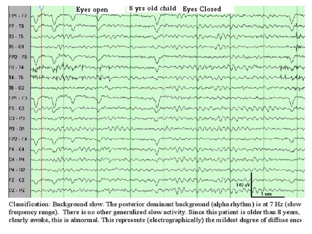 Normal awake and sleep EEG | PPT | Parenting Babies and Toddlers ...