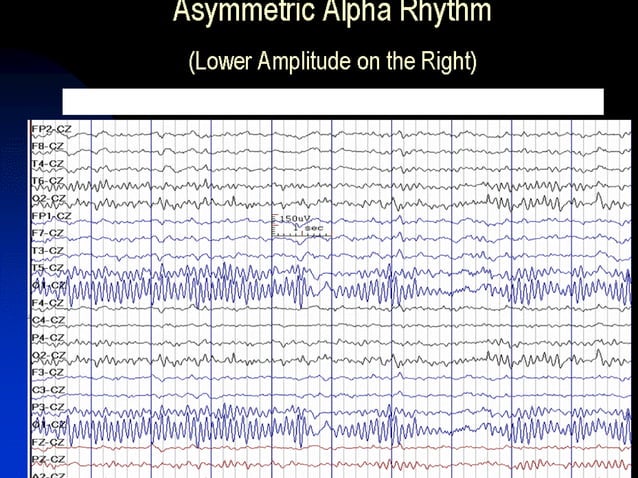 Normal awake and sleep EEG | PPT | Parenting Babies and Toddlers ...