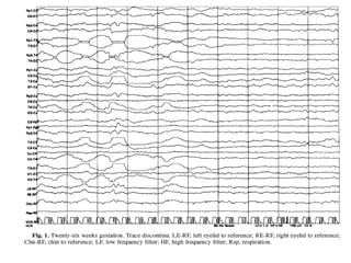 Normal awake and sleep EEG | PPT