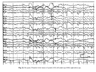 Normal Awake Eeg
