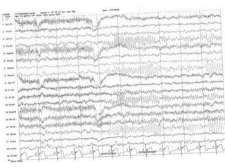 Normal Awake Eeg