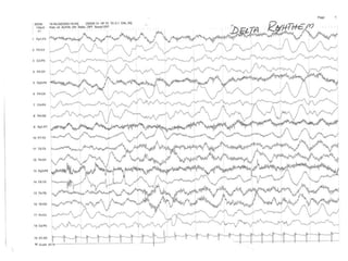 Normal Pediatric Eeg