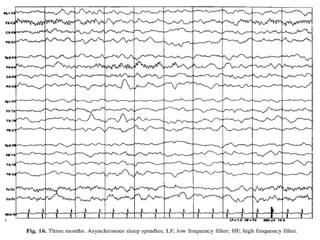 Normal Awake Eeg