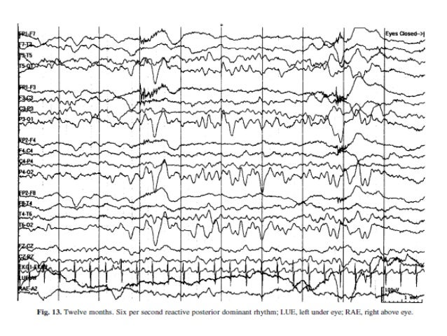 Normal awake and sleep EEG
