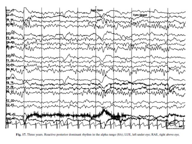 Normal awake and sleep EEG
