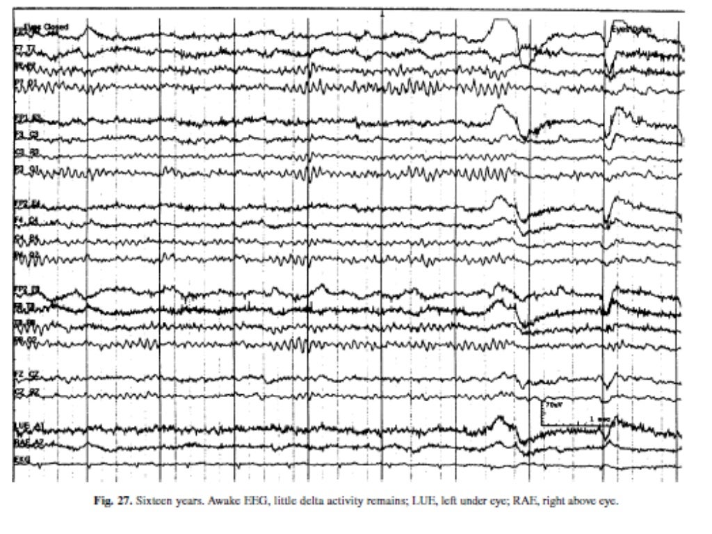 Normal awake and sleep EEG