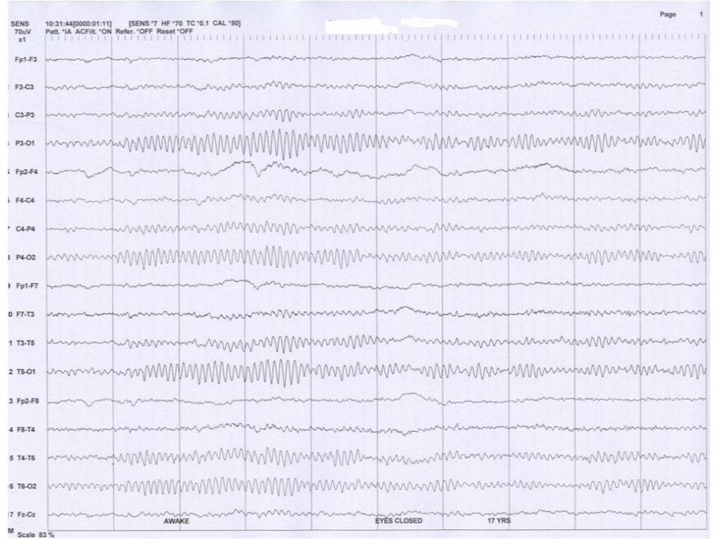 Normal awake and sleep EEG