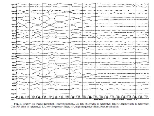 Normal Awake Eeg Spontaneous Seizure In An Scn1a RH/ Mouse.