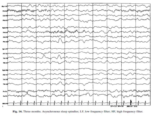 Normal Awake Eeg Spontaneous Seizure In An Scn1a RH/ Mouse.