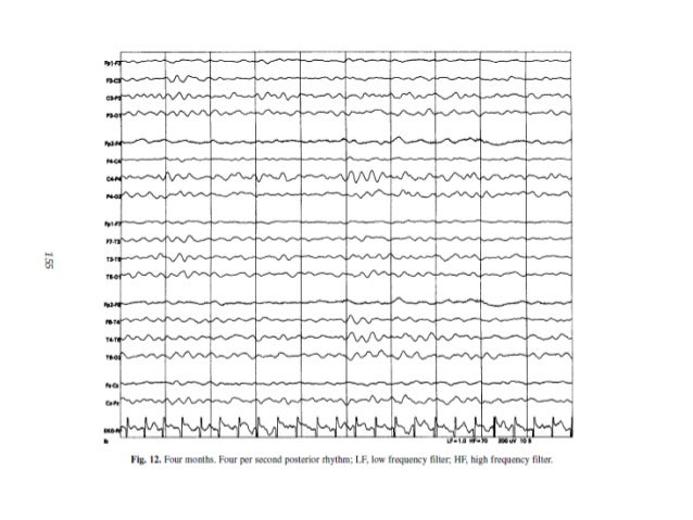 Normal Awake Eeg Spontaneous Seizure In An Scn1a RH/ Mouse.