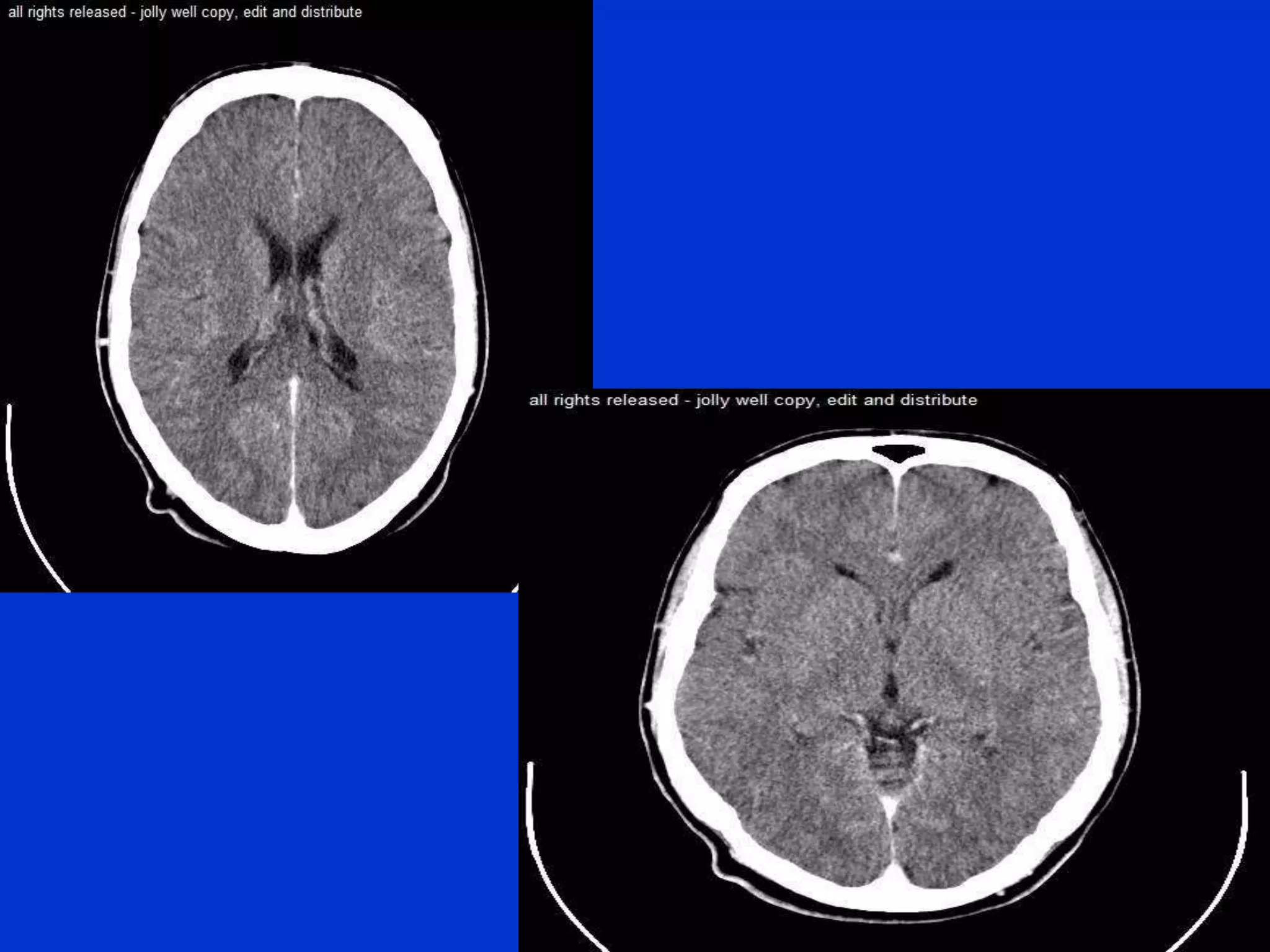 NORMAL BRAIN ANATOMY 2.ppt | Free Download