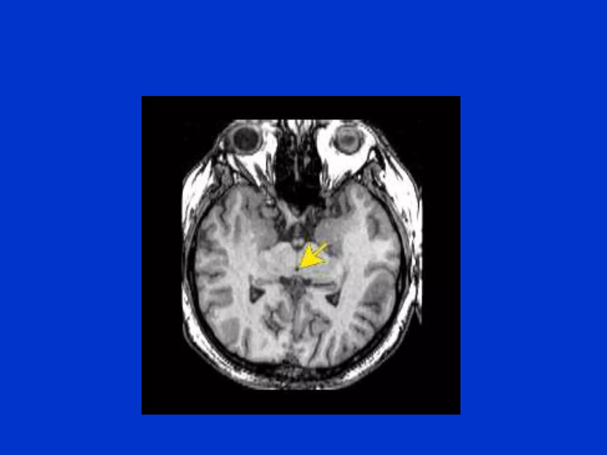 NORMAL BRAIN ANATOMY 2.ppt | Free Download