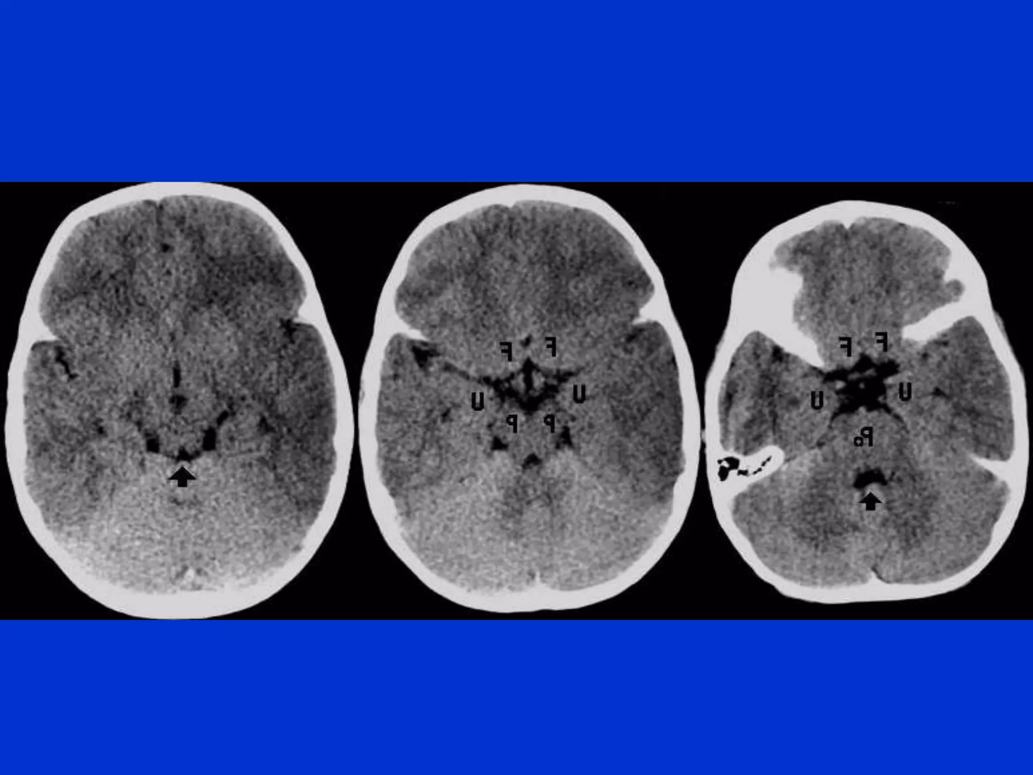 NORMAL BRAIN ANATOMY 2.ppt | Free Download
