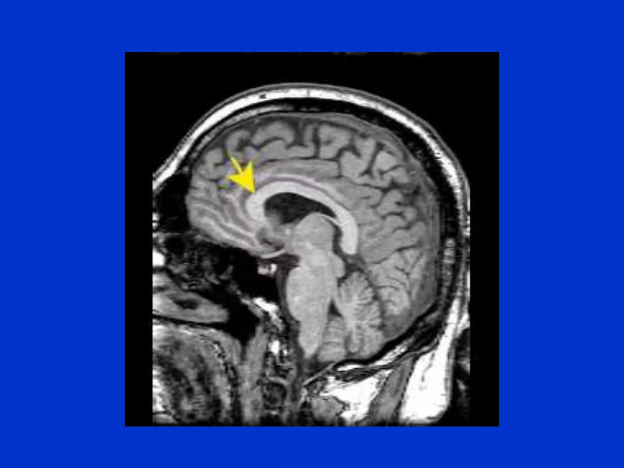 NORMAL BRAIN ANATOMY 2.ppt