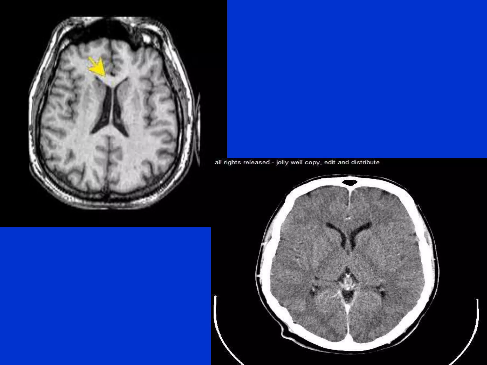NORMAL BRAIN ANATOMY 2.ppt