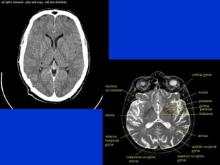 NORMAL BRAIN ANATOMY 2.ppt