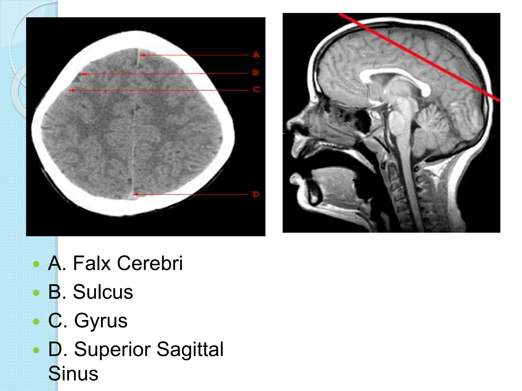 Normal Brain CT Scan Vs Hydrocephalus explained | PPTX | Brain and ...