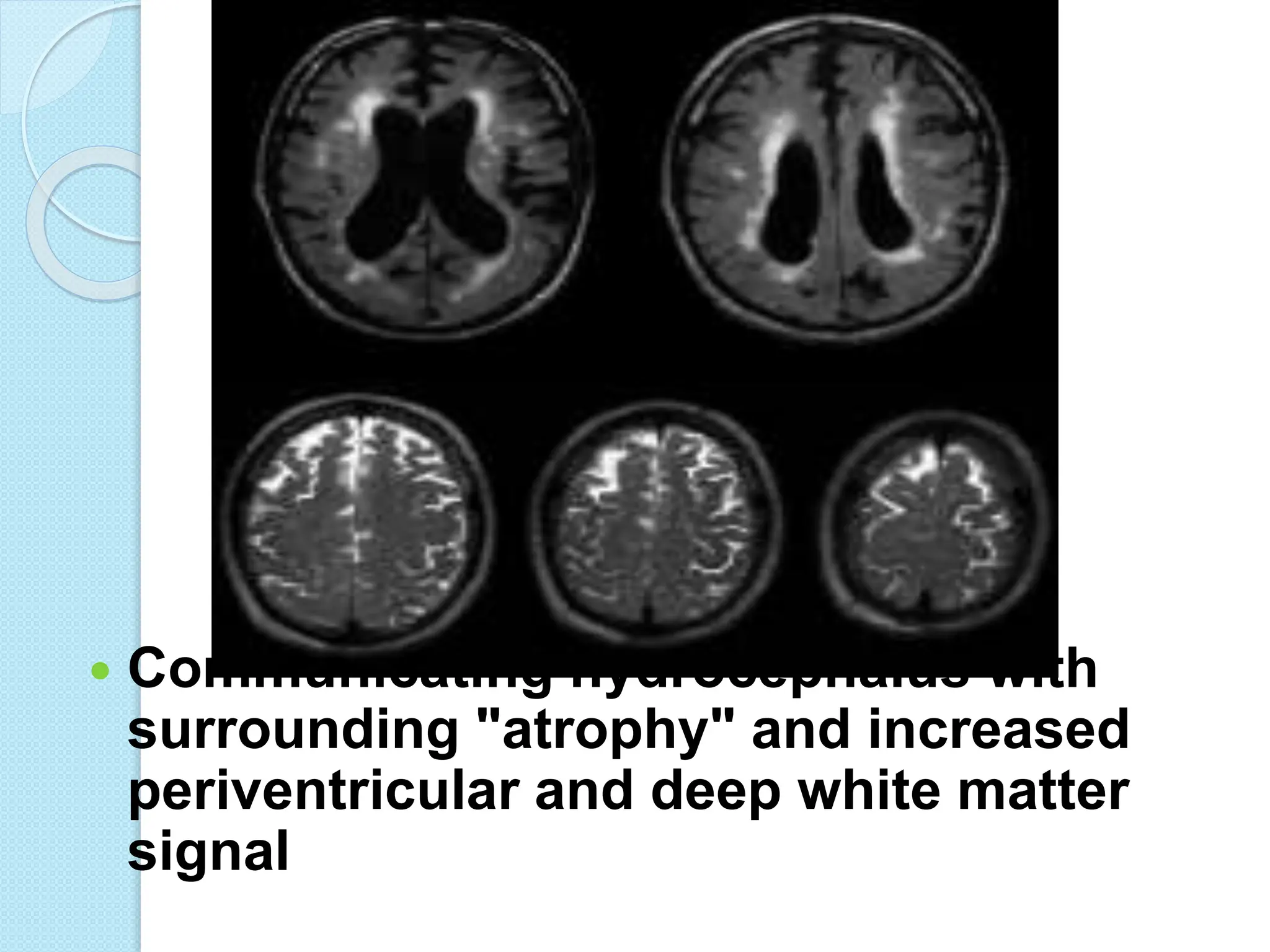 Normal Brain CT Scan Vs Hydrocephalus explained | PPTX