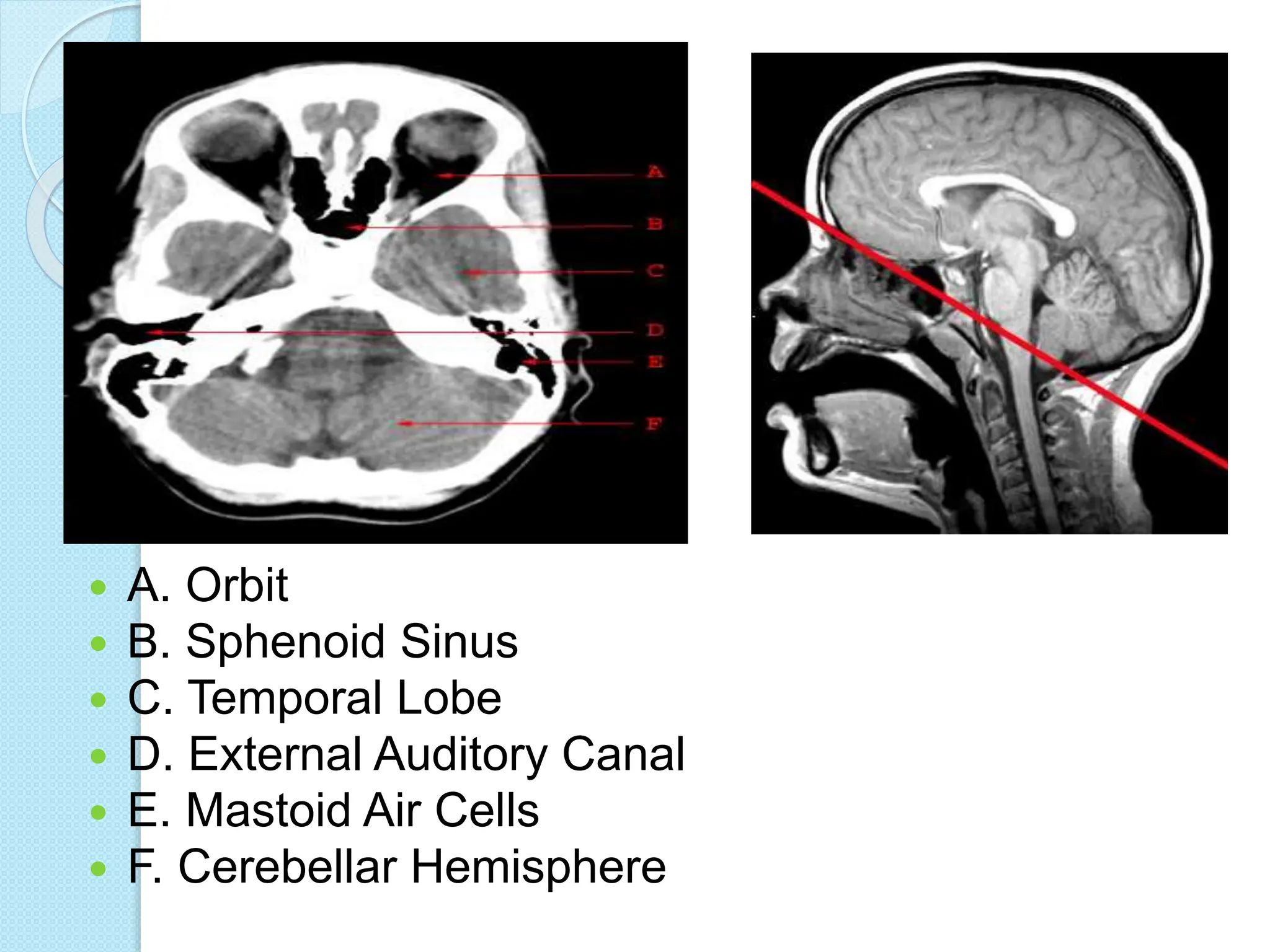Normal Brain CT Scan Vs Hydrocephalus explained | PPTX
