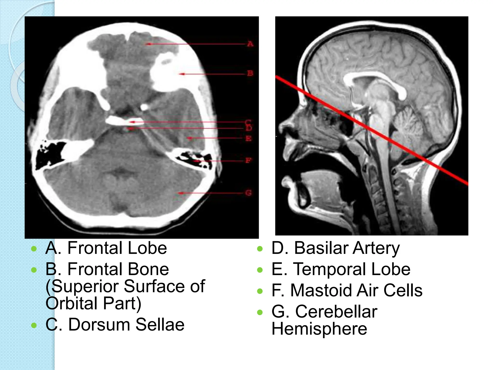 Normal Brain CT Scan Vs Hydrocephalus explained | PPTX