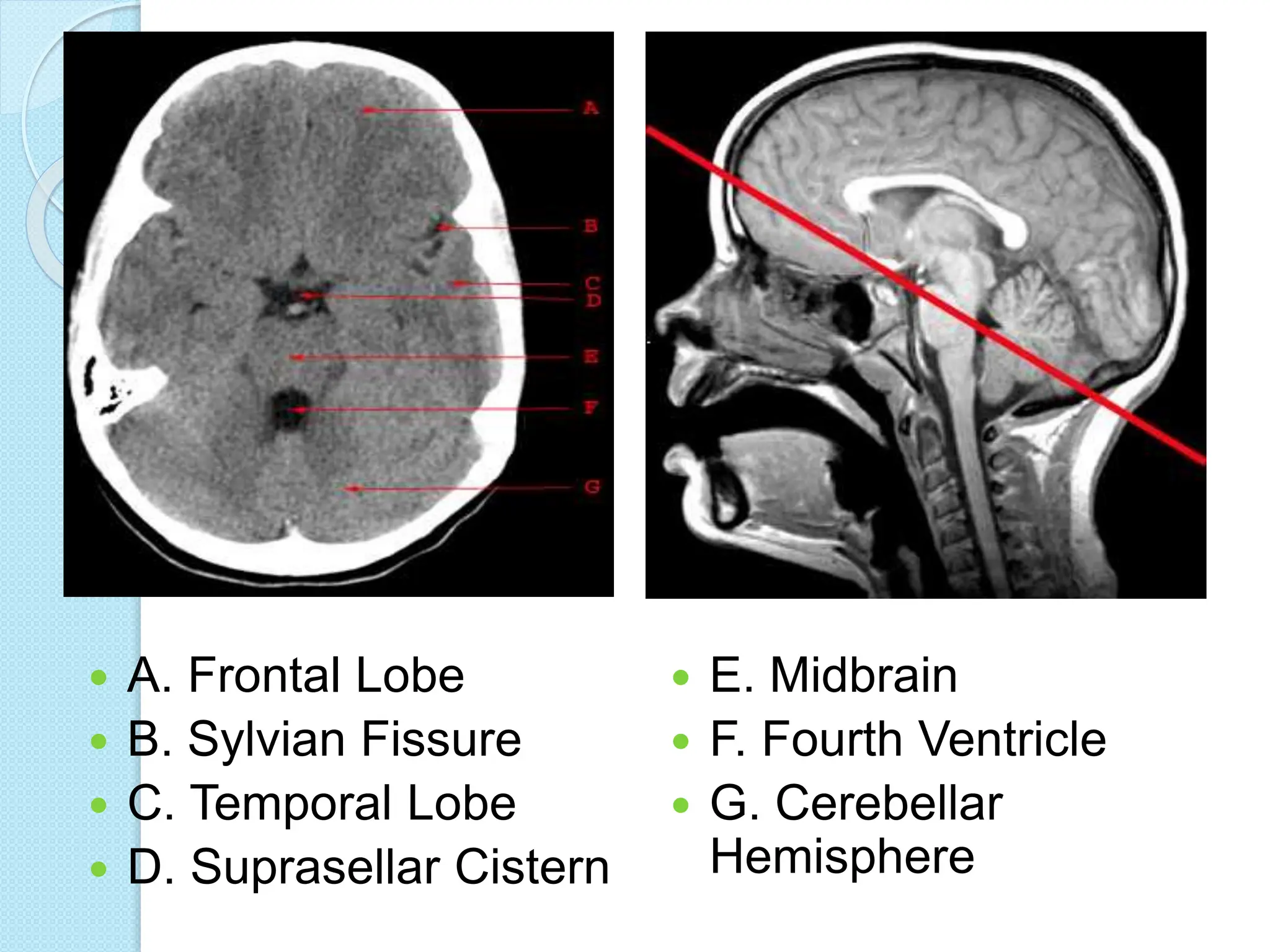 Normal Brain CT Scan Vs Hydrocephalus explained | PPTX