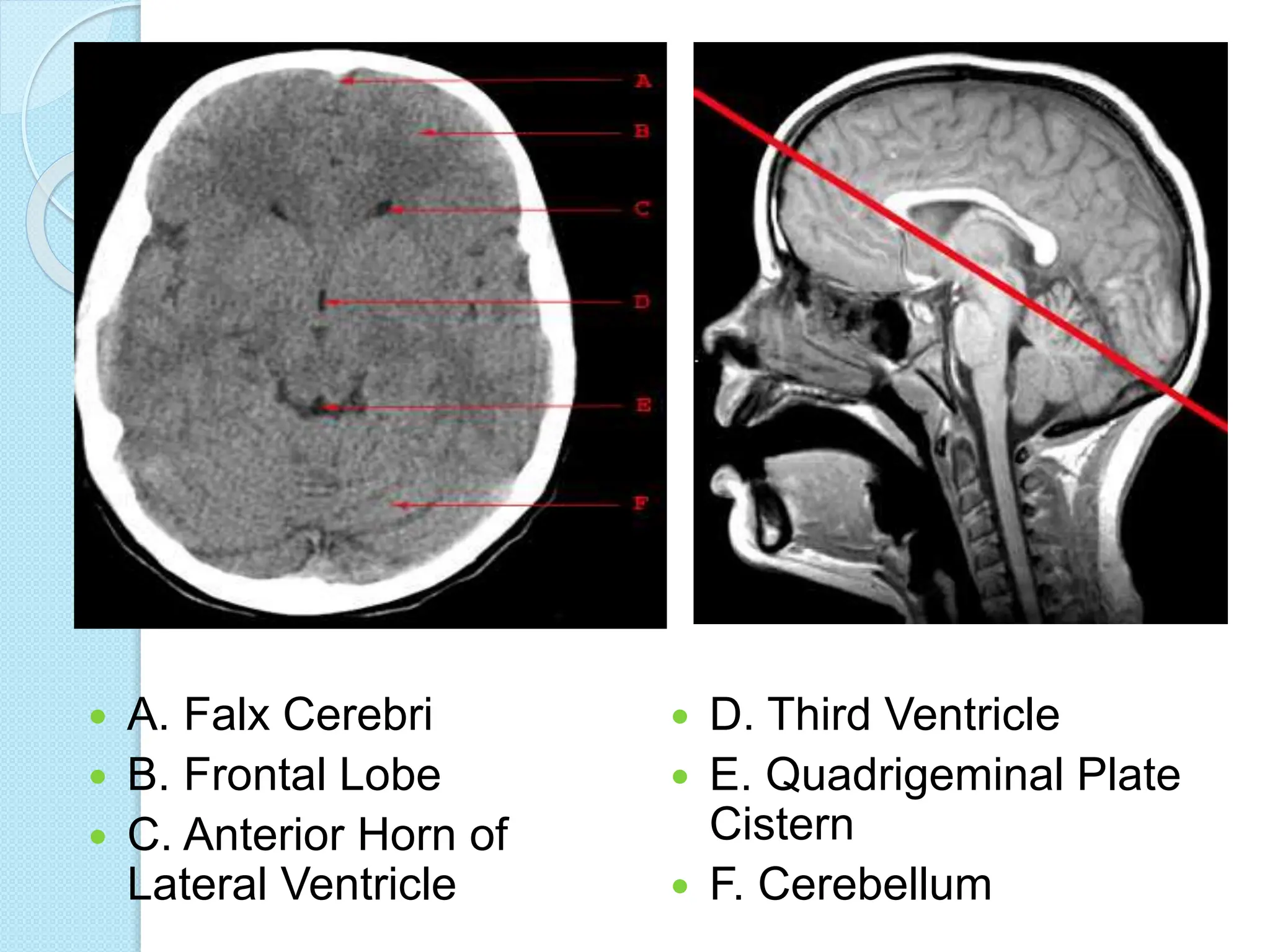 Normal Brain CT Scan Vs Hydrocephalus explained | PPTX | Brain and ...