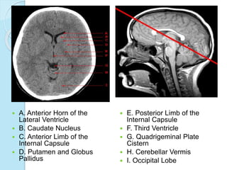 Normal Brain CT Scan Vs Hydrocephalus explained | PPTX