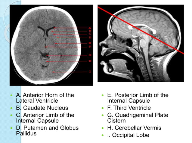 Normal Brain CT Scan Vs Hydrocephalus explained | PPTX | Brain and ...