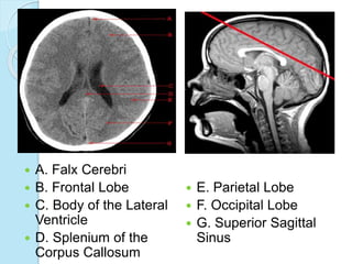 Normal Brain CT Scan Vs Hydrocephalus explained | PPTX