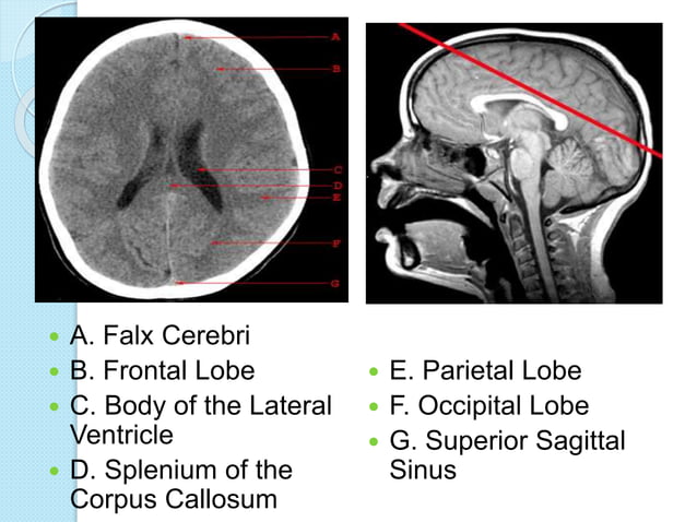 Normal Brain CT Scan Vs Hydrocephalus explained | PPTX | Brain and ...