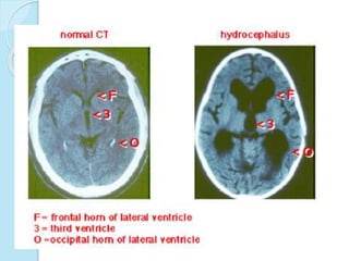 Normal Brain CT Scan Vs Hydrocephalus explained | PPTX