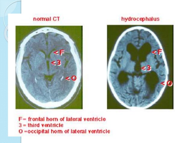 Normal Brain CT Scan Vs Hydrocephalus explained | PPTX | Brain and ...