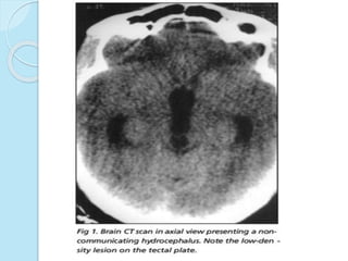Normal Brain CT Scan Vs Hydrocephalus explained | PPTX | Brain and ...