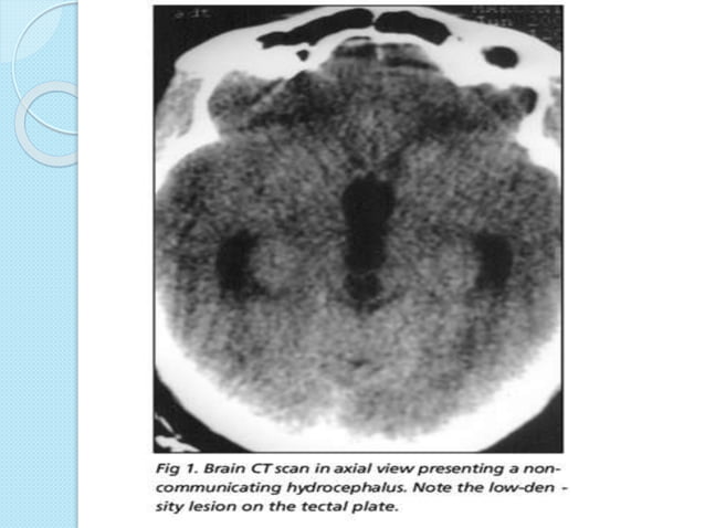 Normal Brain CT Scan Vs Hydrocephalus explained | PPTX | Brain and Nervous System Disorders ...