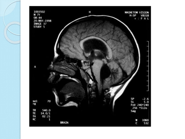 Normal Brain CT Scan Vs Hydrocephalus explained | PPTX | Brain and ...
