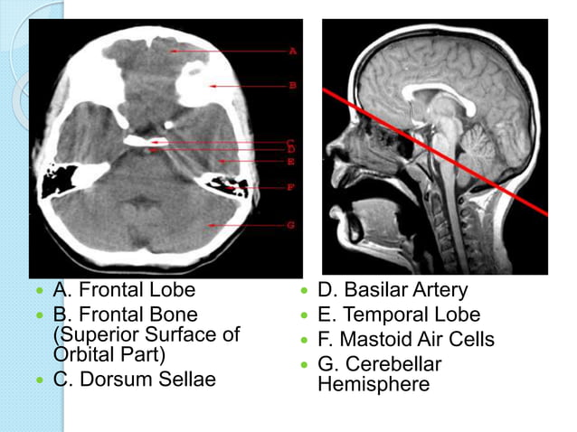 Normal Brain CT Scan Vs Hydrocephalus explained | PPTX | Brain and ...
