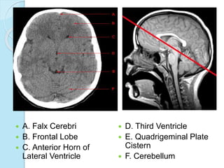 Normal Brain CT Scan Vs Hydrocephalus explained | PPTX
